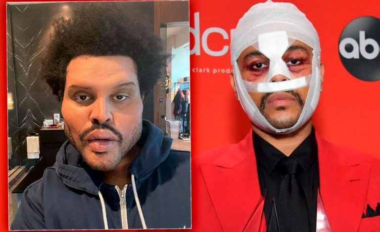 The Weeknd revela o significado de suas polêmicas mudanças no rosto ...